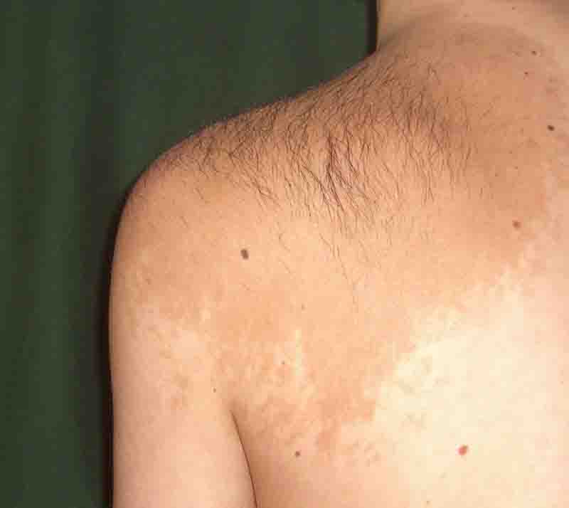 தேமல் மறைய பாட்டி வைத்தியம் | Thembal Treatment in Tamil - Update Thamizha