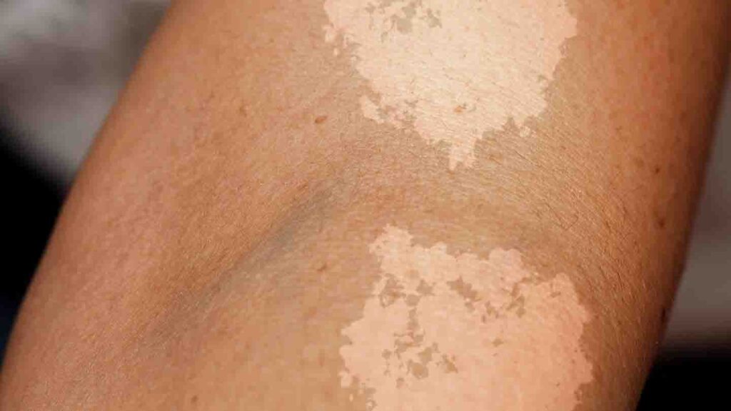 தேமல் மறைய பாட்டி வைத்தியம் | Thembal Treatment in Tamil - Update Thamizha